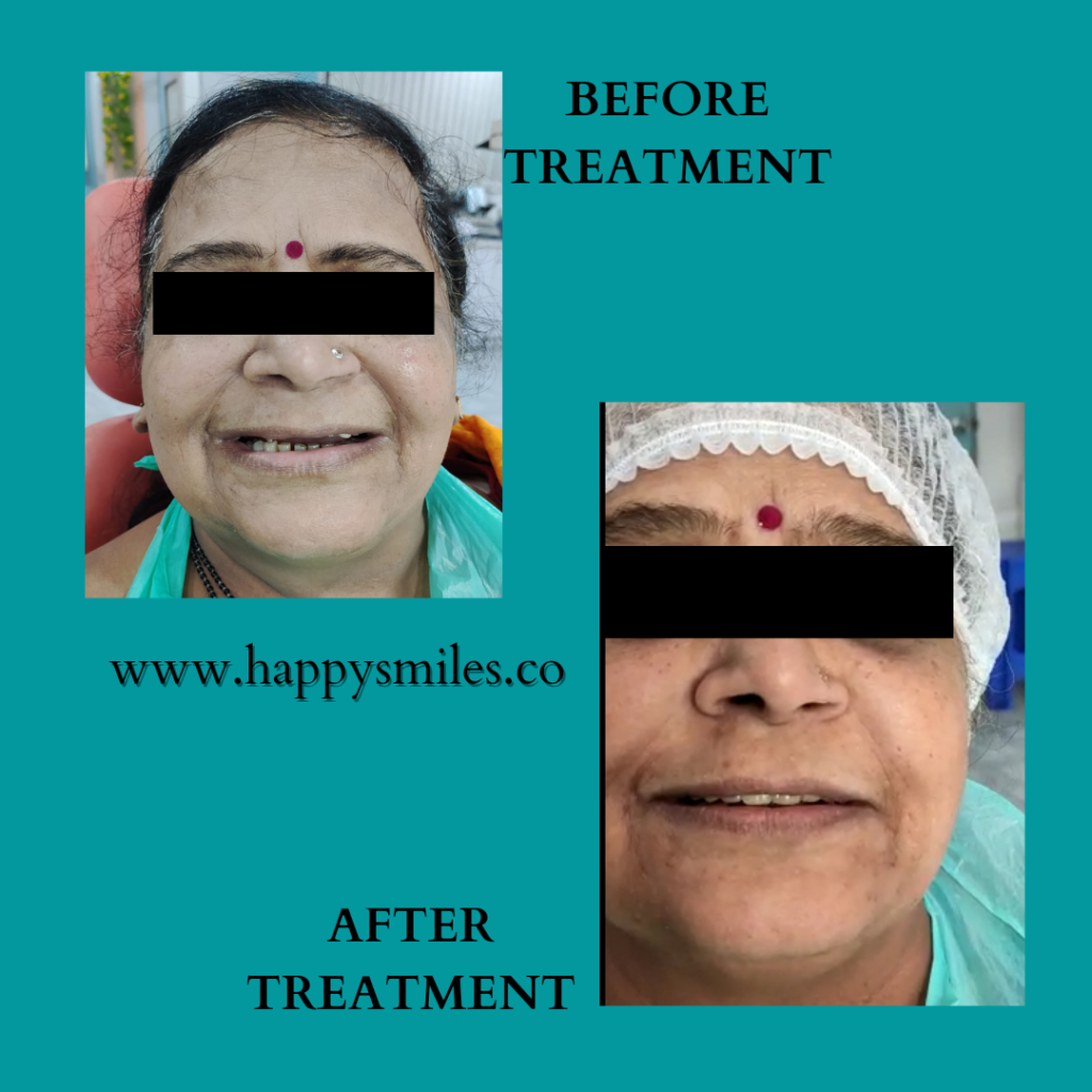 BRINGING BACK SMILE AND FUNCTION - Happy Smiles