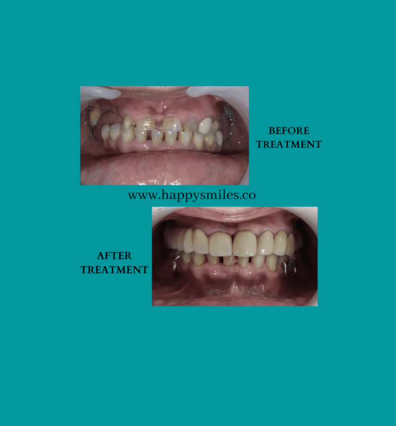 BRINGING BACK SMILE AND FUNCTION - Happy Smiles